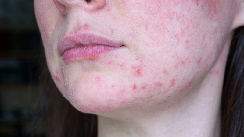 Dermatologové odhalili příčiny akné na bradě | DámskýDeník.cz